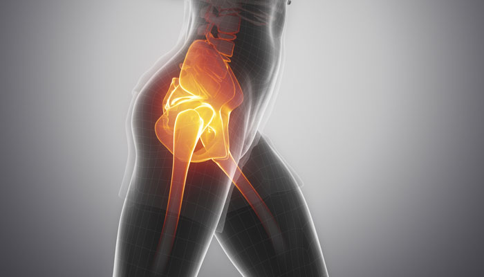 Avascular Necrosis of the Hip and Why You Need to Catch It Early ...